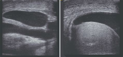 Scrotal Edema Ultrasound Hennepin Ultrasound Testicular Pain