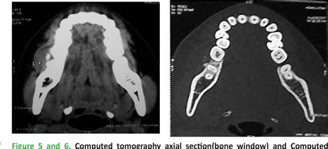 Figure 1 From Gingival Calcifying Epithelial Tumor A Rare Case Report