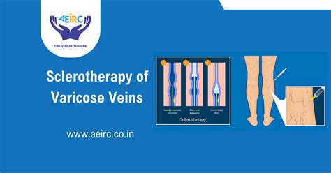 Sclerotherapy Of Varicose Veins And Spider Veins Aeirc Clinic Jaipur