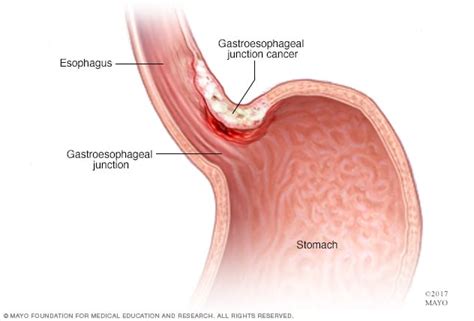 Que Sintomas Tiene El Cancer De Estomago Cancerwalls