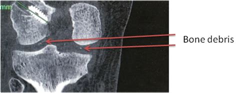 Remnant Bone Debris After Acl Reconstruction Surgery A Cause Of