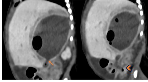 Subhepatic Appendicular Perforation In A Neonate A Great Mimicker Eurorad