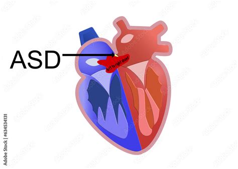 Vecteur Stock The Picture Shows Atrial Septal Defect Or Asd And The