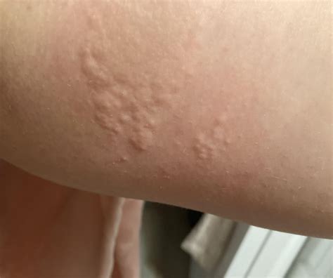 Raised Localized Rash 33f Raskdocs