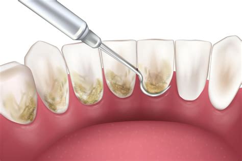 Le surfaçage radiculaire Dentisterie Laval