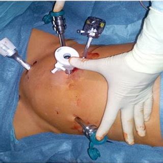 Position Of Ports For The Procedure Download Scientific Diagram