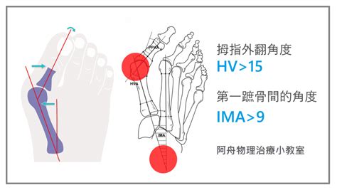 【知識】拇趾外翻怎麼辦？深度剖析『拇指外翻』的原因 文章 運動筆記