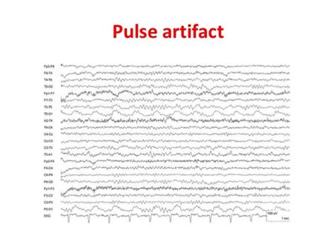 Eeg Artifacts