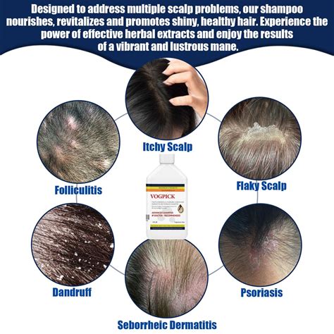 Folliculitis Shampoo Seborrheic Dermatitis Shampoo
