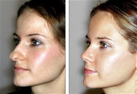 Rhinoplasty Uk Surgeons Nose Jobs And Reconstruction Surgeons
