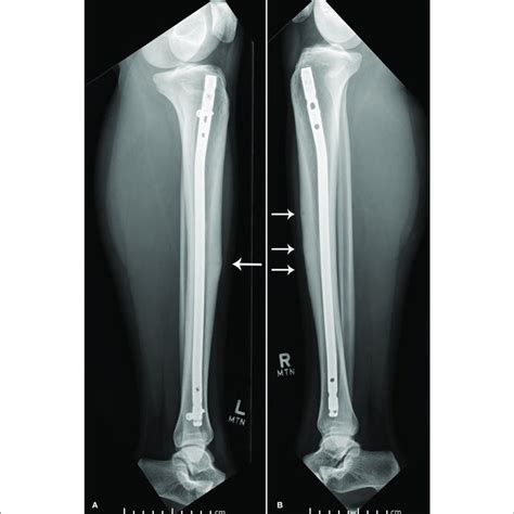 Lateral X Ray Of Left A And Right B Tibia And Fibula Download Scientific Diagram