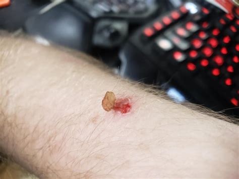 Itchy Scab From A Minor Burn Wasnt Ready To Come Off Yet R Peeling