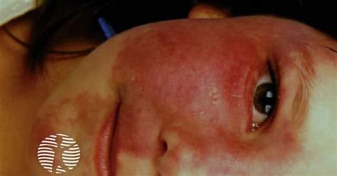 Vascular Malformation Image