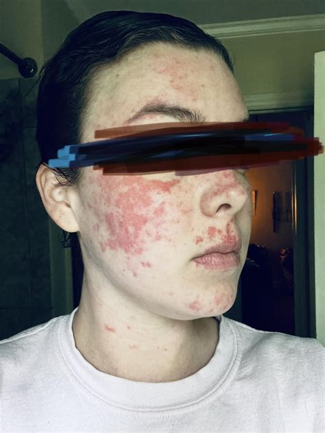 Rash R Lupus