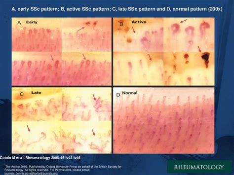 Systemic Sclerosis Scleroderma