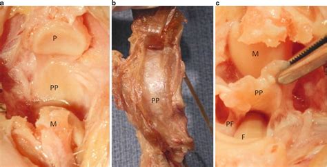 Lesser Metatarsal Osteotomy Complications Musculoskeletal Key