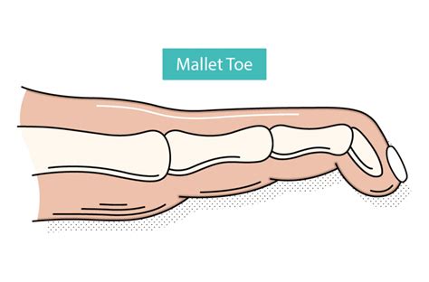 Hammer Toe Causes Diagnosis And Treatment The Foot Hub