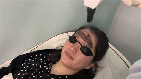 Nd Yag Laser Training Tattoo Removal And Carbon Peeling Stelle Laser