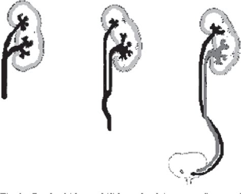 Figure 3 From Bilateral Triple Renal Pelvis A Case Report Obostrani