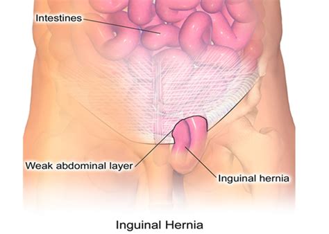 Inguinal Hernia Diagnosis Treatment London General Surgery Clinic