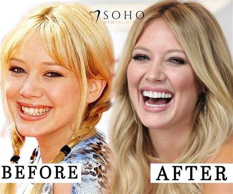 Hilary Duff Veneers Before And After Hollywood Smile And Dental Veneers