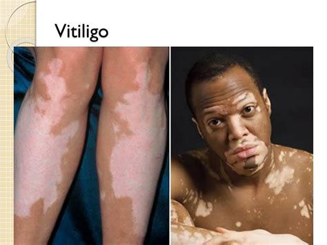Ppt Skin Disorders Understanding Common Integumentary Diseases