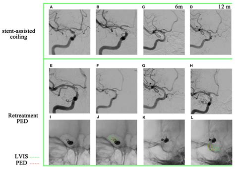 Retreatment With A Pipeline Embolization Device For Recanalized Aneurysms Following Stent