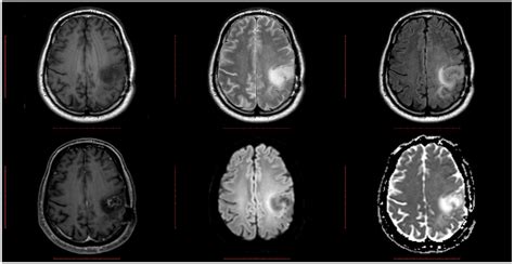 Evaluating Brain Tumor Detection With Deep Learning Convolutional Neural Networks Across