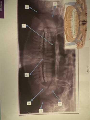 Radiology Board Review Flashcards Quizlet