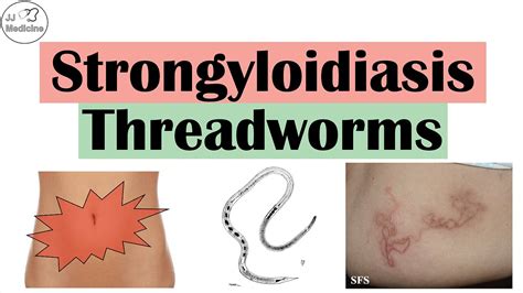 Strongyloidiasis Threadworms Causes Pathophysiology Signs And