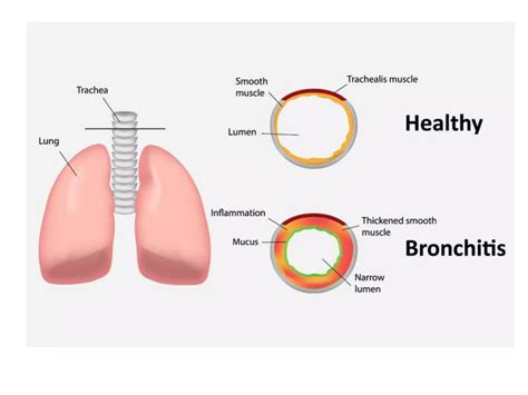 Obstructive Bronchitis Pptx