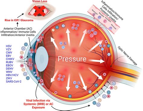 Congenital Glaucoma Diagram