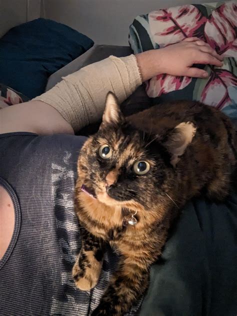 Day After Decompression Surgery On Nhs Ama R Cubitaltunnel