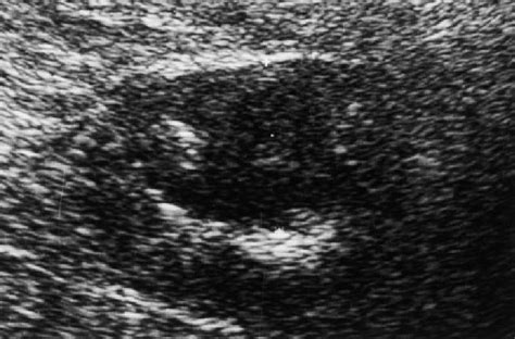 69 Year Old Woman With Colonic Carcinoma Transverse Ultrasound Shows