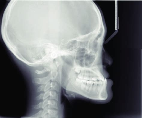 Pretreatment Cephalometric Radiograph Download Scientific Diagram