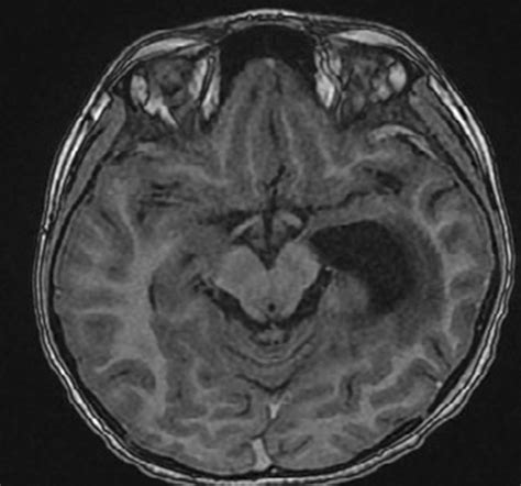 Postsurgery T1wi Showing A Resection Cavity In The Left Temporoparietal Download Scientific