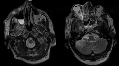 Mri Of The Head Axial View Reveals Abnormal T2 Hyperintense Signals In