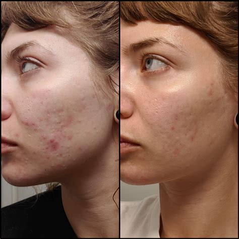 List 93 Pictures Tretinoin Cream 005 Before After Pictures Completed