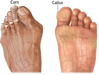 Difference Between Corn And Callus Corn Vs Callus