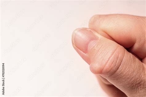 Hygroma Ganglion Cyst Of The Thumb Joint Selective Focus Stock