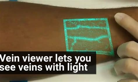 Nidhi Goyal On Linkedin Veinviewer Means No More Poking People