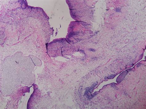 Sarcoma Botryoides Embryonal Rhabdomyosarcoma Cervix
