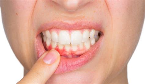 A Tooth Infection Can Spread To Your Body