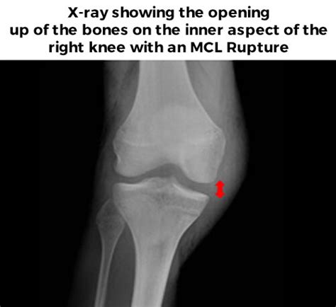 Complex Ligament Injuries Mclpcl Surgeons And Consultants Yorkshire