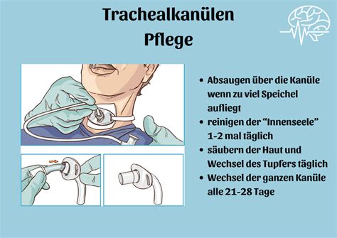 Kanüle nach Schlaganfall Pflege Prognose beim Tracheostoma