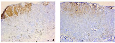 A Nodular Melanoma Stage Pt1a In A 65 Year Old Male Patient The