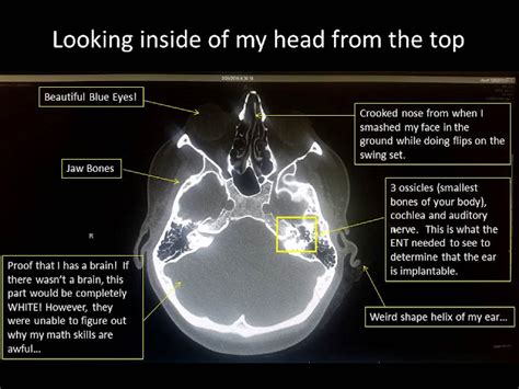Hear My Voice See My Words Beginning My Cochlear Implant Journey