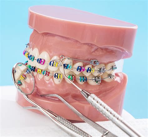 Braces And Aligners Dr Jayas Orthodontic And Dental Clinic