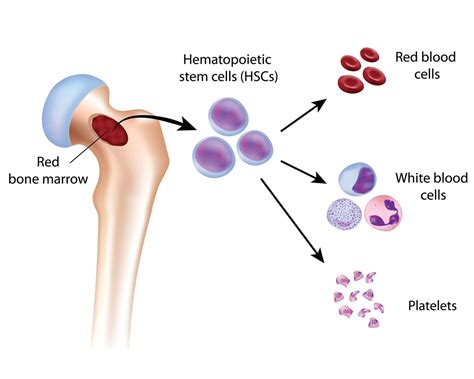 Myelodysplastic Syndrome Symptoms Causes Types Top 4 Ultimate Risk