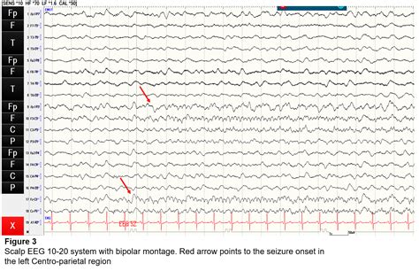 Using Intraoperative Ecog For Limited Focal Resection In The Treatment Of Super Refractory